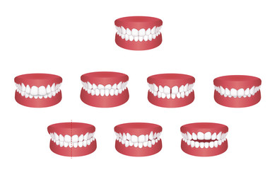 Teeth trouble bite type crooked overbite Vector Image