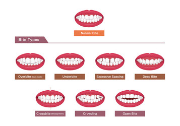 Teeth trouble bite type set Royalty Free Vector Image