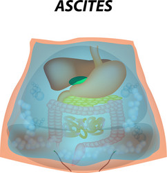 Paracentesis Vector Images (29)