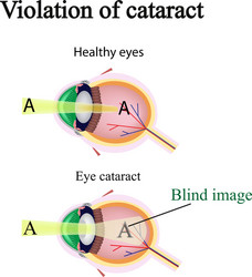 Structure of the eye eye cataracts affected Vector Image