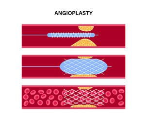 Stent Vector Images (over 130)