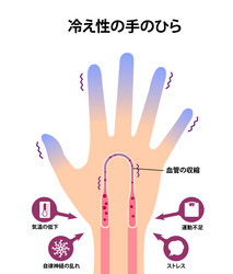 Cold hand blood circulation sensitivity to Vector Image
