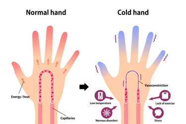 Comparison of normal hand and cold hand Royalty Free Vector