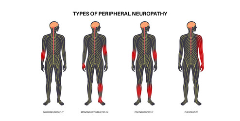 Peripheral neuropathy medical poster Royalty Free Vector