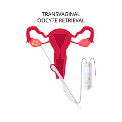 Ovarian hyperstimulation flat composition Vector Image