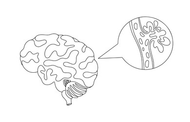 Ischemic stroke one line Royalty Free Vector Image