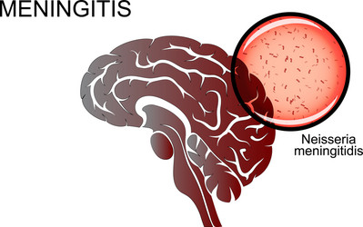 Viral meningitis and encephalitis Royalty Free Vector Image