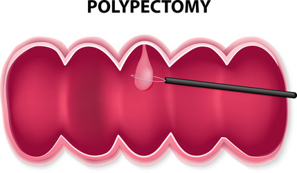 Polypectomy Vector Images (19)