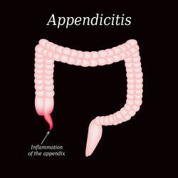 Appendicitis inflammation of the appendix colon Vector Image