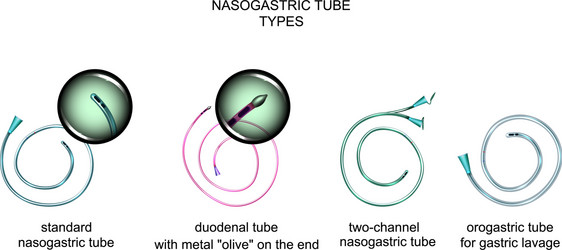 Nasogastric tube in the stomach Royalty Free Vector Image