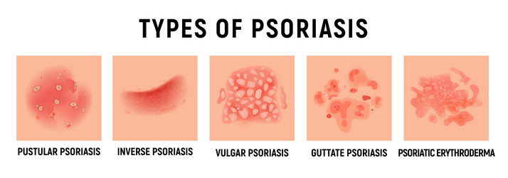 Psoriasis and normal skin layers detailed Vector Image