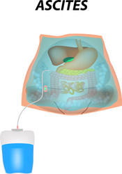 Paracentesis Vector Images (29)