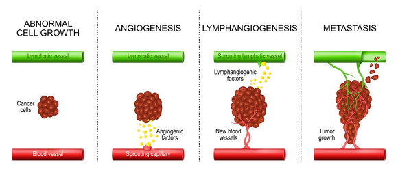 Tumor angiogenesis Royalty Free Vector Image - VectorStock