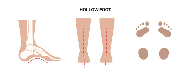 Hollow feet anatomy Royalty Free Vector Image - VectorStock