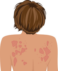 Eczema Vector Images (over 4,500)