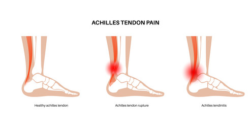 Achilles tendon injury Royalty Free Vector Image