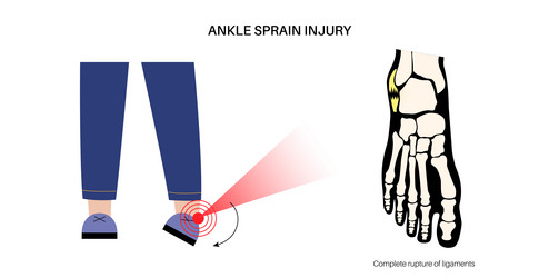 Sprained ankle injury Royalty Free Vector Image