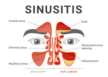 Sinusitis healthy nasal sinus Royalty Free Vector Image