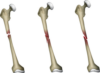Bone Fracture Vector Images (over 7,400)
