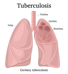 Lung Tubercle Tuberculosis Vector Images (14)