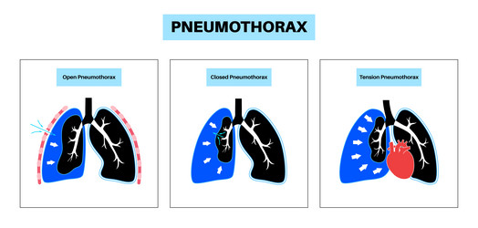 Pneumothorax anatomical poster Royalty Free Vector Image