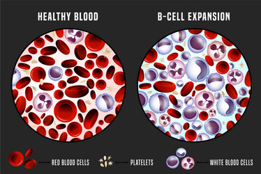 Leukemia medical infographic Royalty Free Vector Image