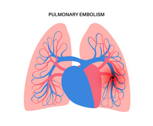 Pulmonary Embolism - Blood Clot in Lung Royalty Free Vector