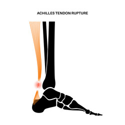 Achilles tendon injury Royalty Free Vector Image