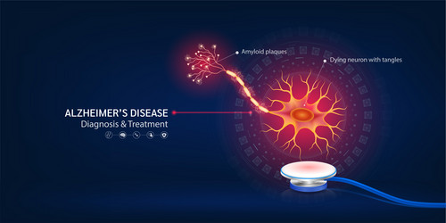 Alzheimer disease human brain Royalty Free Vector Image