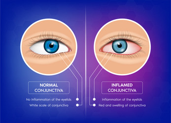 Normal conjunctiva and conjunctivitis Royalty Free Vector