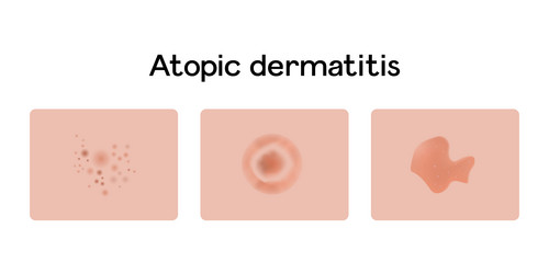 Atopic dermatitis symptoms and treatment icon set Vector Image