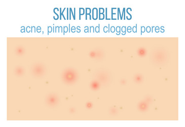 Top view of problem skin Royalty Free Vector Image