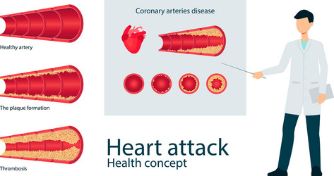 Atherosclerosis infographic with normal Royalty Free Vector