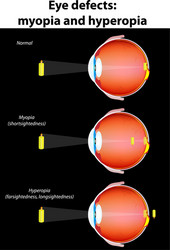 Optical human eye defects myopia and hyperopia Vector Image
