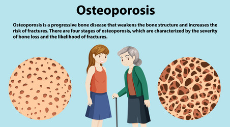 Bone density and osteoporosis Royalty Free Vector Image