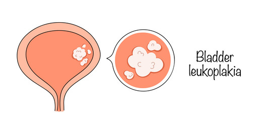 Bladder Trauma Royalty Free Vector Image Vectorstock