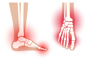 Rheumatoid arthritis stages infographics Vector Image