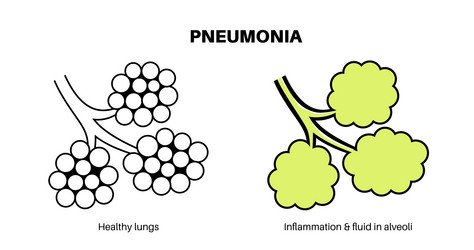 Pneumonia infection poster Royalty Free Vector Image