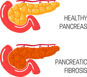 Cystic Fibrosis Vector Images (over 330)