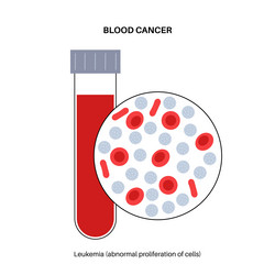 Acute Myeloid Leukemia Vector Images (over 120)