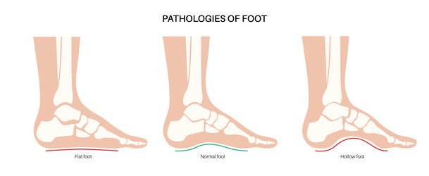 Foot pathologies poster Royalty Free Vector Image