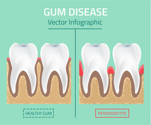 Gingivitis or scurvy brushing teeth with bleeding Vector Image