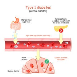 Type 1 Diabetes Diagram Pancreas