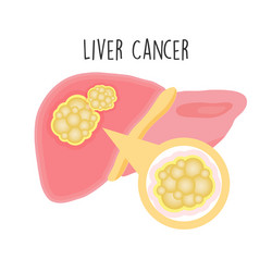 Liver Cancer Infographic Vector Images (over 310)
