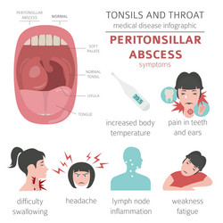 Tonsils and throat diseases peritonsillar abscess Vector Image