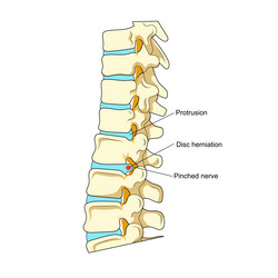 Low back pain in man diagram medical science Vector Image
