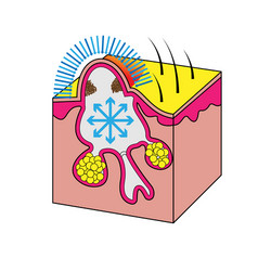 Acne treatment poster Royalty Free Vector Image