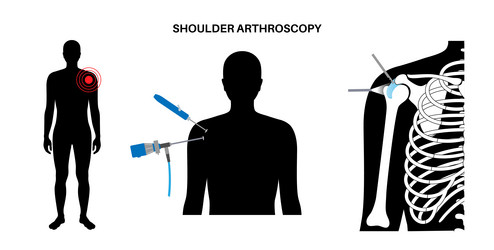 Shoulder arthroscopy poster Royalty Free Vector Image