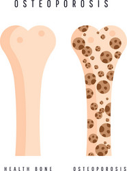 Osteoporosis bone and healthy Royalty Free Vector Image