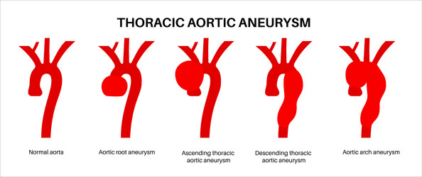Thoracic aortic aneurysm Royalty Free Vector Image